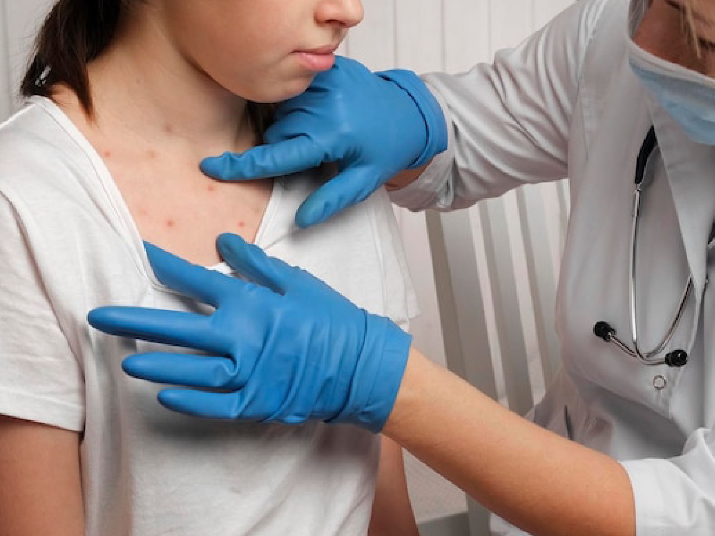 Mpox: What Are the Symptoms and How to Prevent It? || Jakarta Smart City